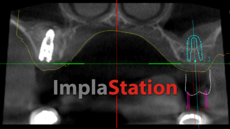 Implantation Planning Using The Technique Of Closed Sinus Lifting And ...