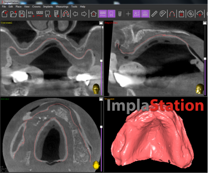 FULL ADENTIA - Surgical guides & Implantation planning software free ...