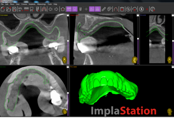 FULL ADENTIA - Surgical guides & Implantation planning software free ...
