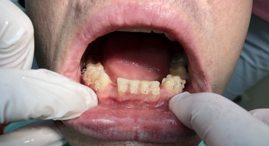 Implant placement on restricted mesiodistal space | ImplaStation case