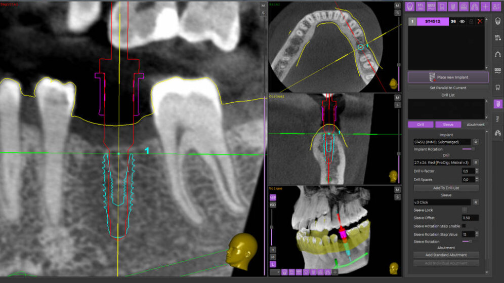 Guided Surgery Kit Mistral v3 for Surgical Guides | ProDigiDent