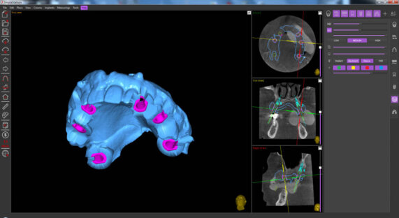 Full Edentulous Jaw: Universal double scanning technique | ImplaStation