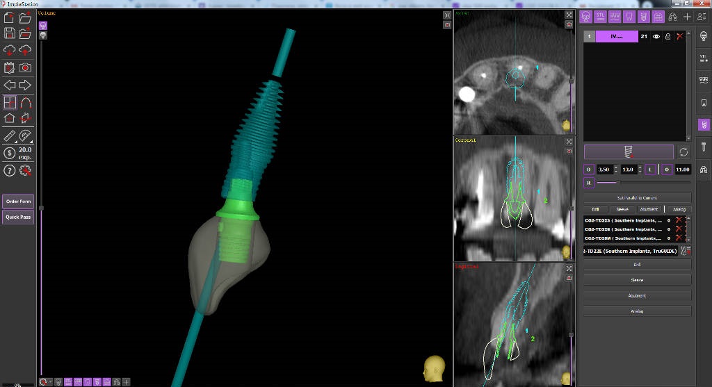 3D planning of Southern Implants INVERTA Co-Axis immediate implant ...