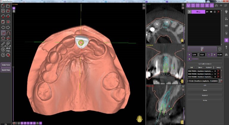 3D planning of Southern Implants INVERTA Co-Axis immediate implant ...