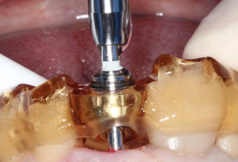 3D planning of Southern Implants INVERTA Co-Axis immediate implant ...