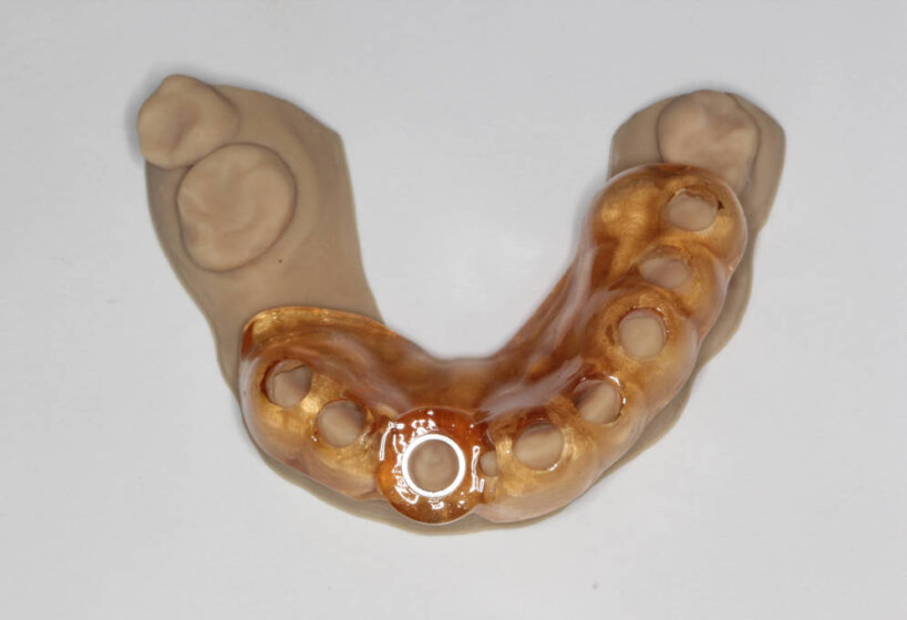 3D planning of Southern Implants INVERTA Co-Axis immediate implant ...
