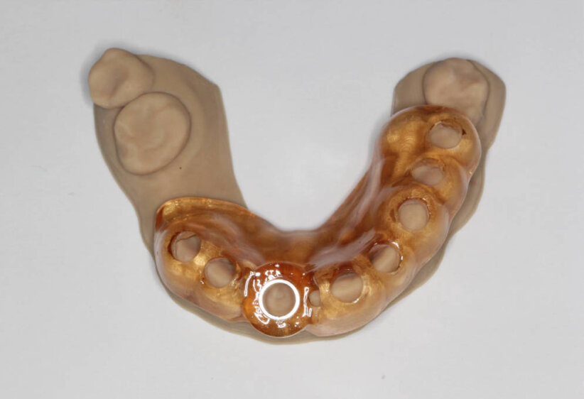 3D planning of Southern Implants INVERTA Co-Axis immediate implant ...