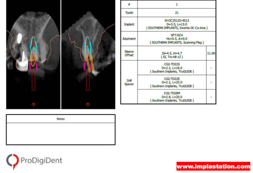 3D planning of Southern Implants INVERTA Co-Axis immediate implant ...