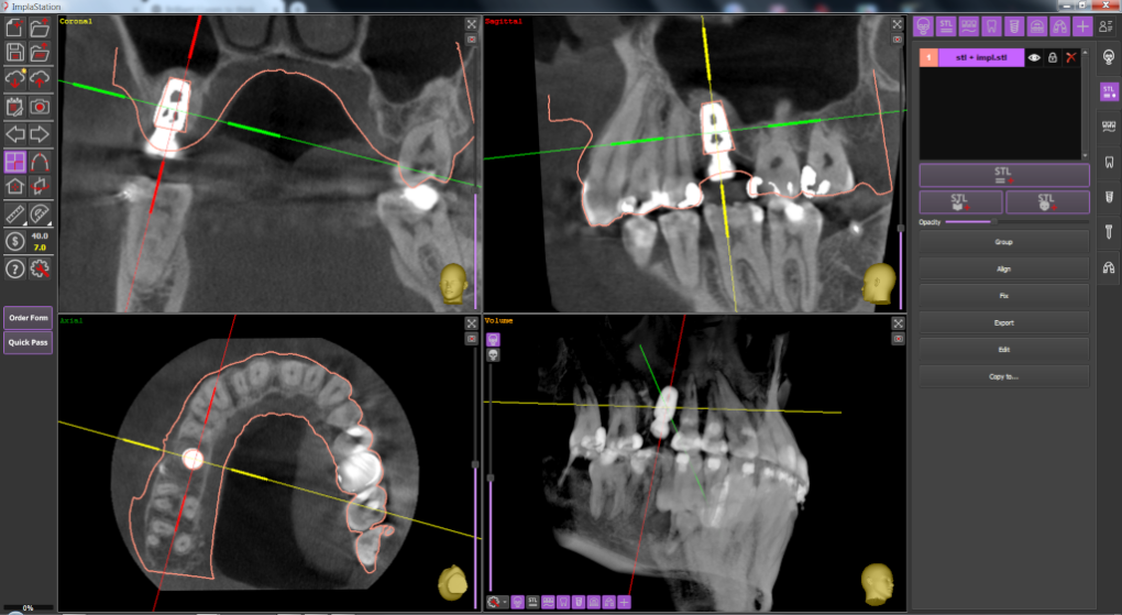 Closed sinus lift - Surgical guides & Implantation planning software ...