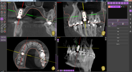 Closed sinus lift - Surgical guides & Implantation planning software ...