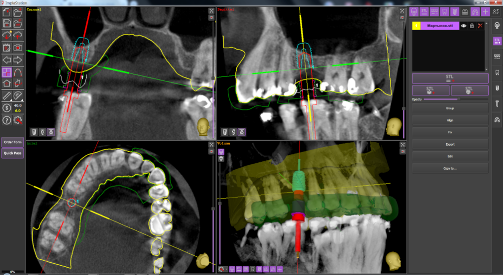 Closed sinus lift - Surgical guides & Implantation planning software ...