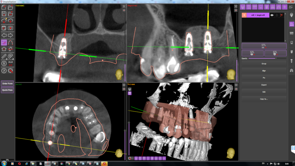 Implants placed by transcrestal-guided sinus floor elevation technique - Surgical guides ...