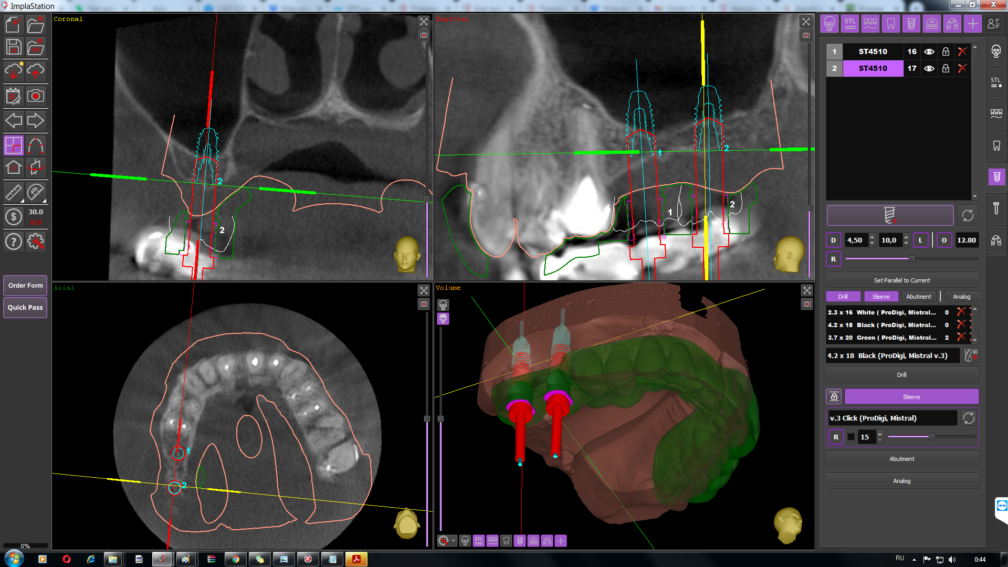 Implants placed by transcrestal-guided sinus floor elevation technique - Surgical guides ...