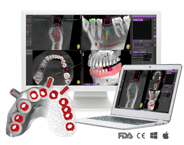Surgical Guides & Implant Planning Software | ImplaStation