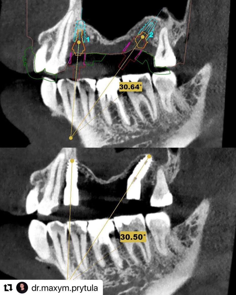 Guided surgery as an alternative to subantral augmentation - Surgical ...