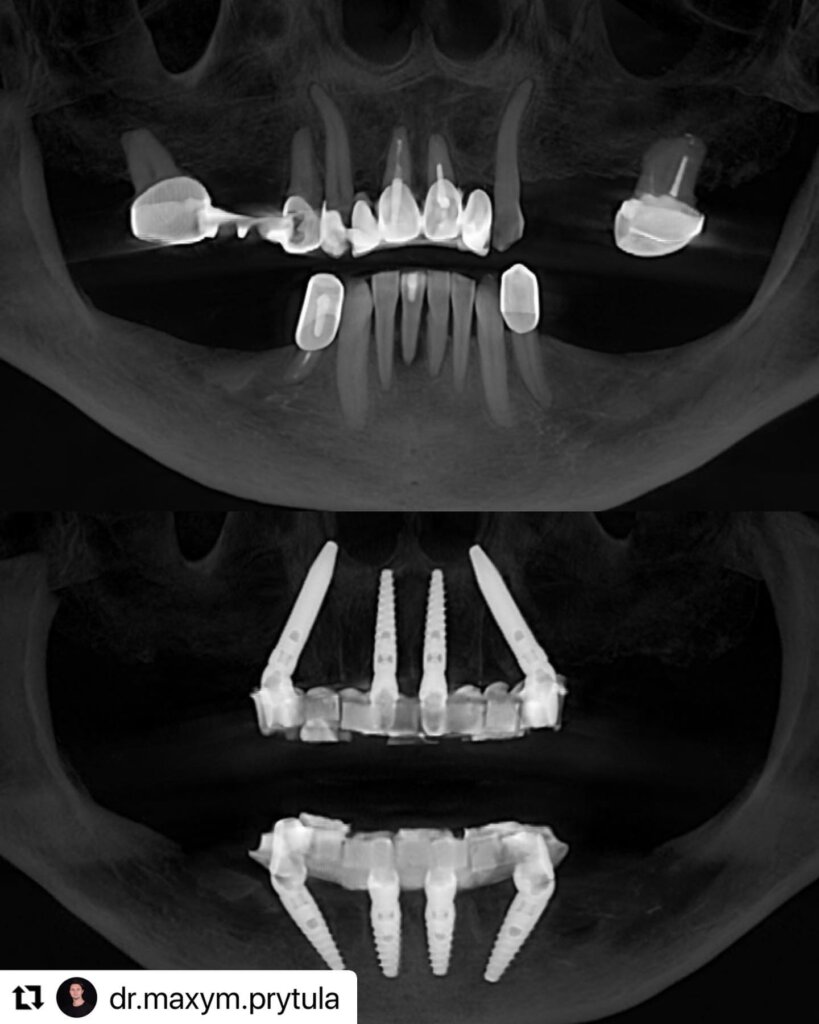 All-on-4 full-arch rehabilitation with stackable surgical guides ...