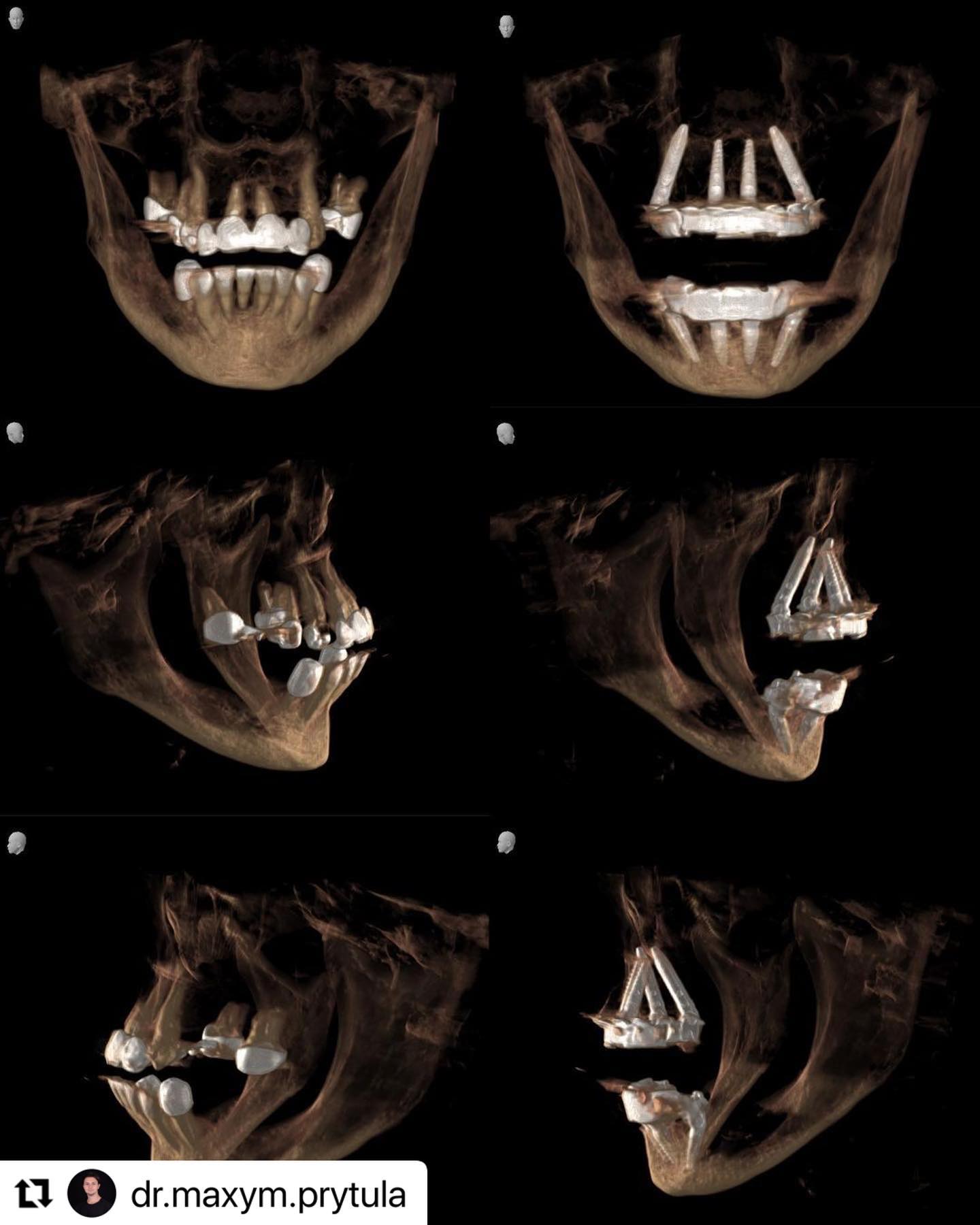 All-on-4 full-arch rehabilitation with stackable surgical guides ...