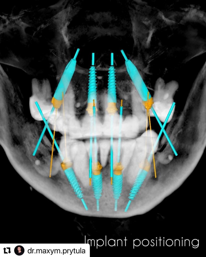 All-on-4 full-arch rehabilitation with stackable surgical guides ...