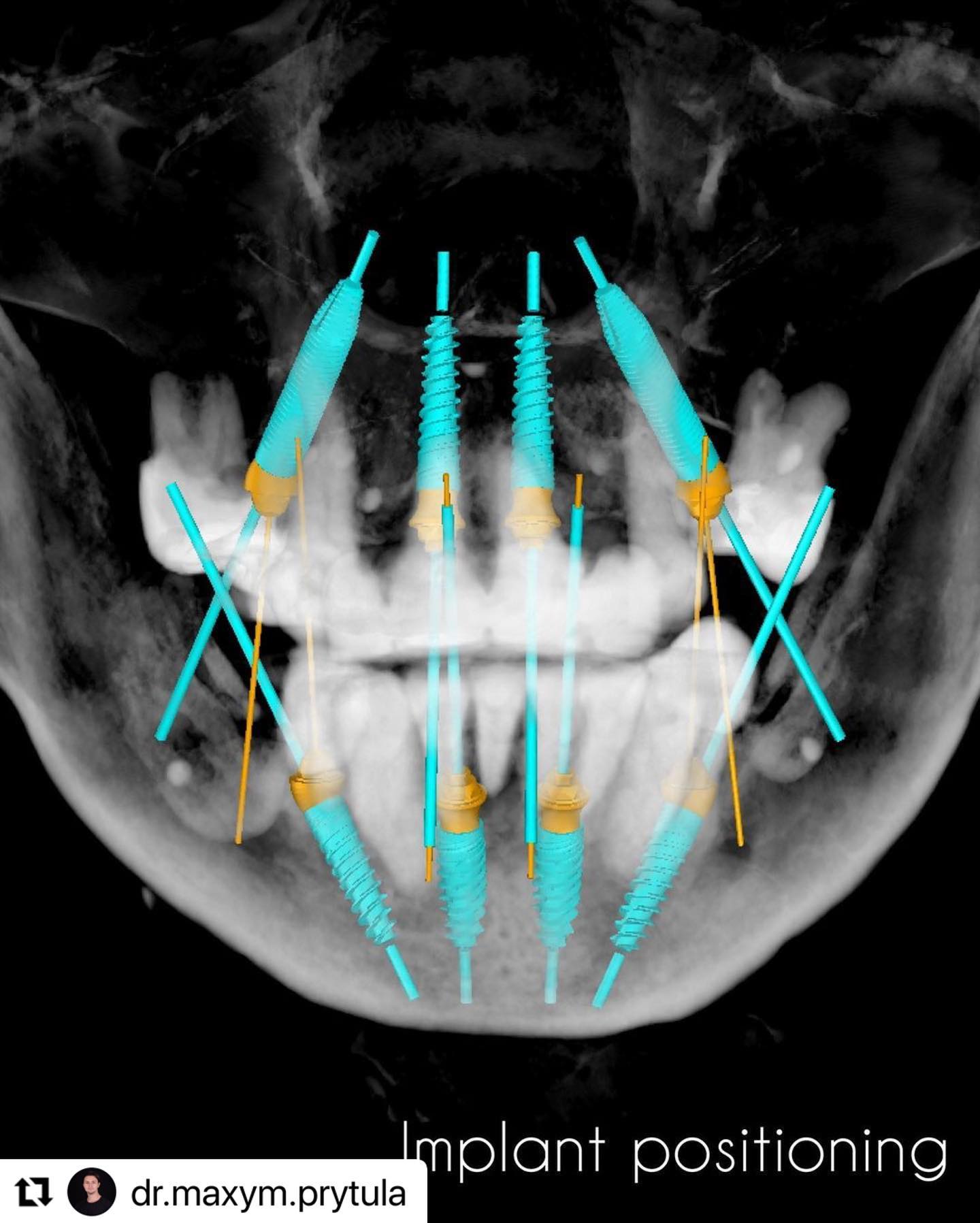 All-on-4 full-arch rehabilitation with stackable surgical guides ...
