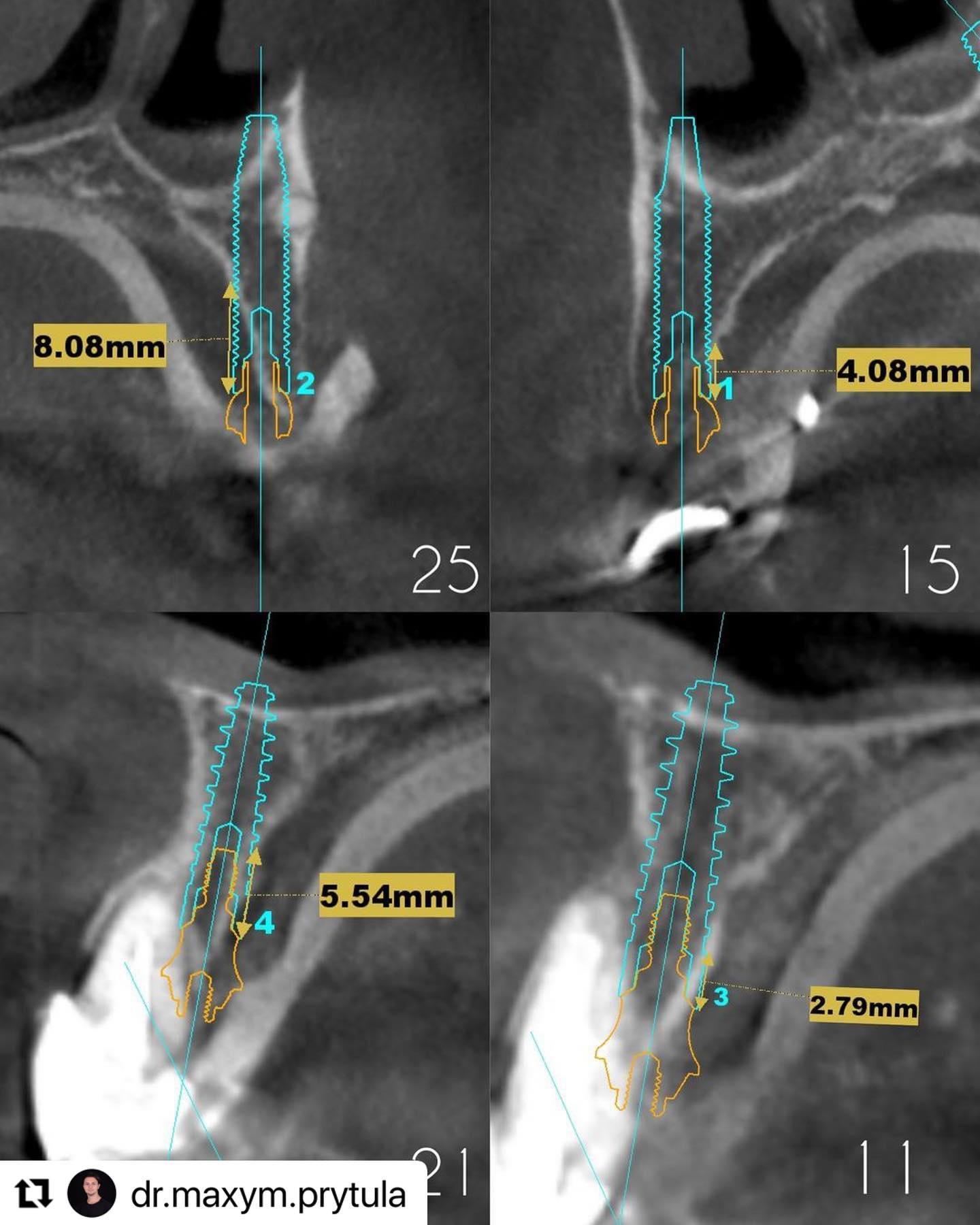 All-on-4 full-arch rehabilitation with stackable surgical guides ...
