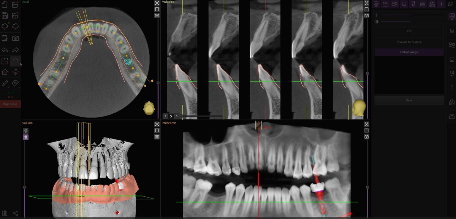 Videos Archive - Surgical guides & Implantation planning software free ...